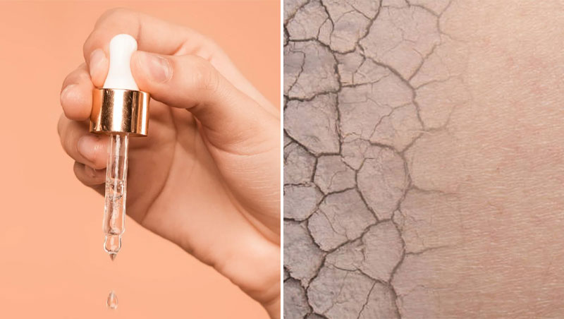 Estas son las diferencias entre la piel seca y la piel deshidratada