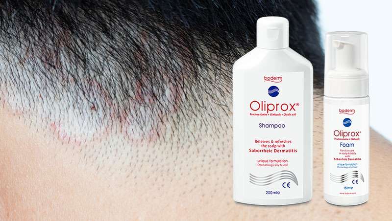 La solución contra la tiña