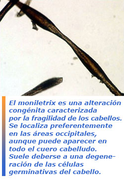 El moniletrix, una alteración estructural del cabello